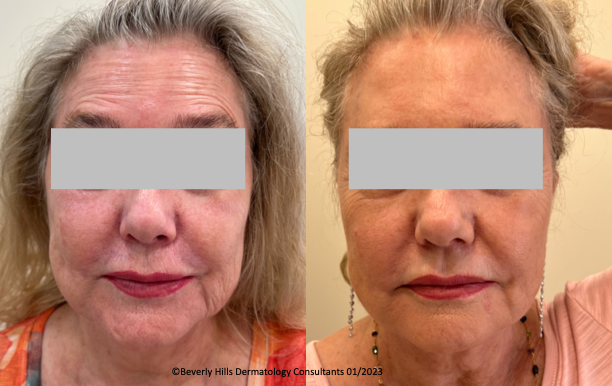 Beverly Hills Dermatology Consultants™ Blog | Letantia Bussell, M.D ...