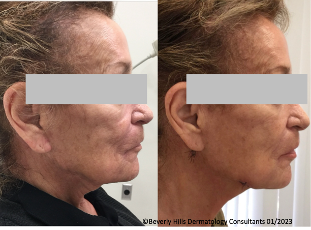 Beverly Hills Dermatology Consultants™ Blog | Letantia Bussell, M.D ...